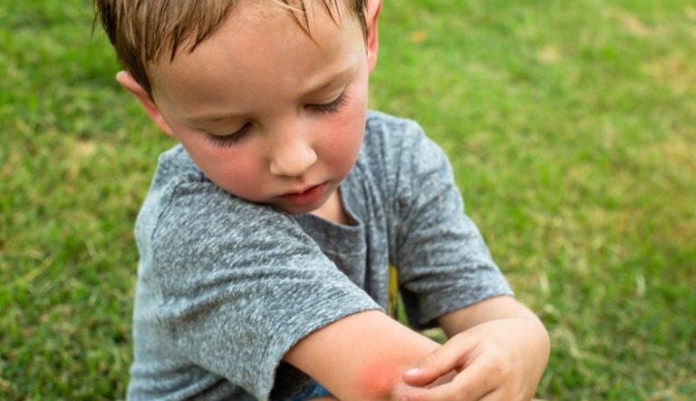 Picadas de Insetos: 6 Tipos, Sintomas e 5 Formas de Prevenir